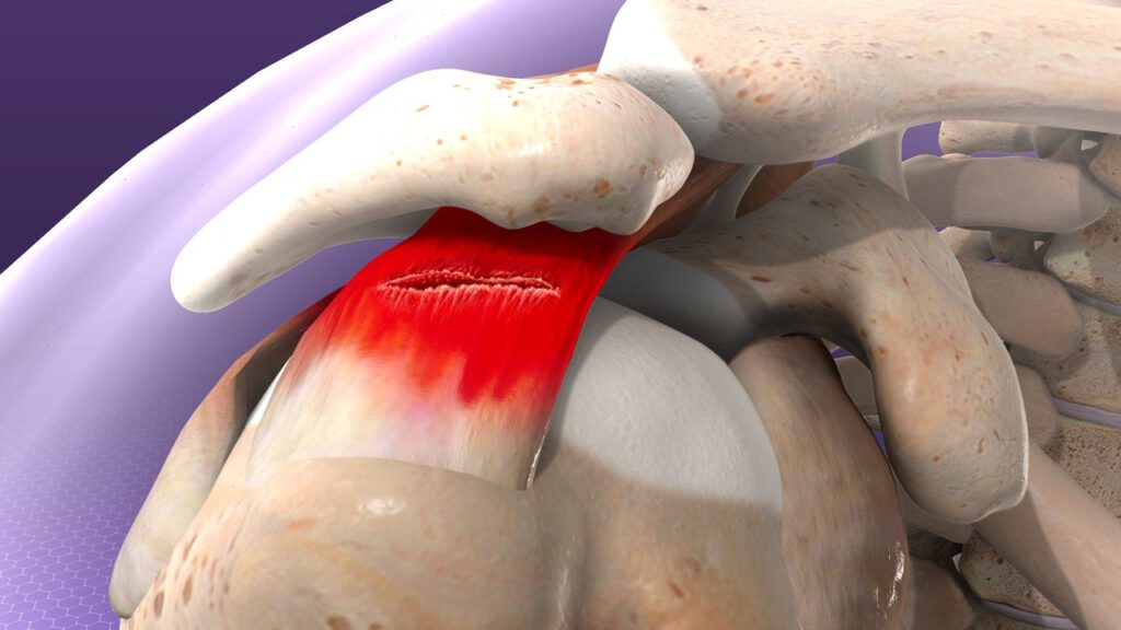 Shoulder Impingement - React Physical Therapy